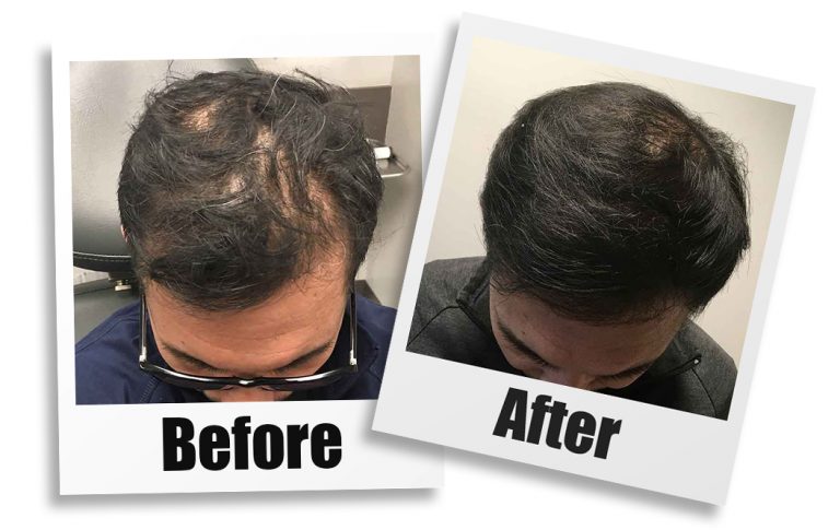 Prp With Acell Hair Restoration In Seattle Bellevue And Kirkland